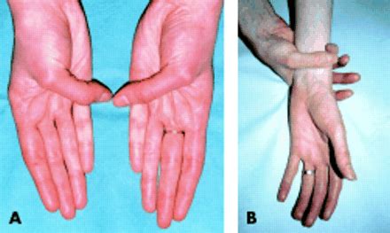 Management Of Marfan Syndrome Heart