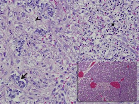 Chronic Pancreatitis Histology