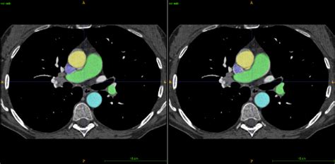 Automatic Lung Cancer Staging Using Ct Data Ntnumedicine