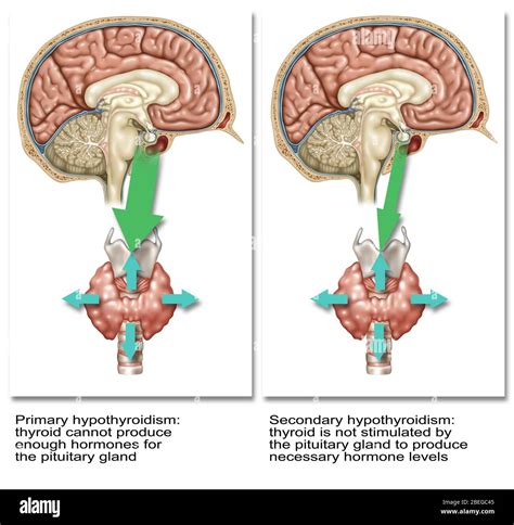 Secondary Hypothyroidism Cut Out Stock Images And Pictures Alamy