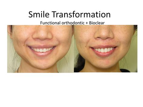 Functional Orthodontics Culver City Ca Link Dental Excellence