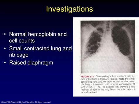 Ppt Chapter 5 Diffuse Interstitial Pulmonary Fibrosis Powerpoint Presentation Id 6401261