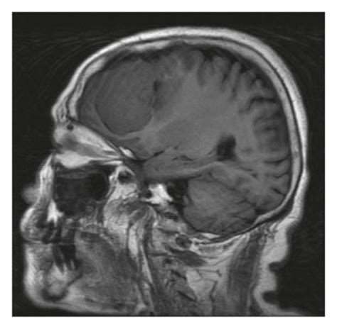 Mri Image Of A Patient With Psammomatous Type Of Meningioma Male 33 Download Scientific