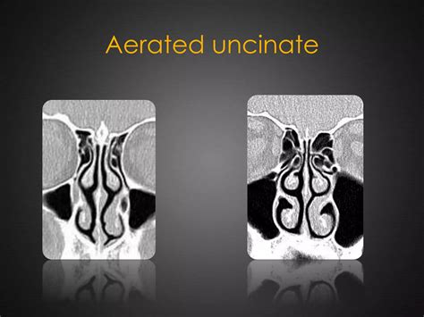 Anatomical Variants Of Ct Pns Pptx