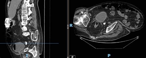 CT Of Abdomen Sagittal View And Corresponding Axial Image The Download Scientific Diagram