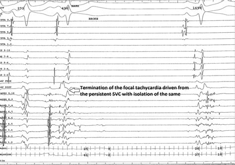 Electrograms Demonstrating Termination Of Atrial Fibrillation On Download Scientific Diagram