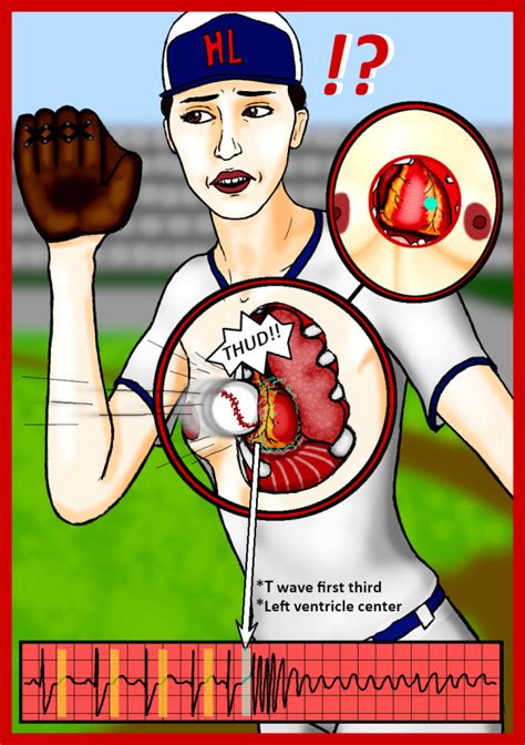 Commotio Cordis Cc Is An Extremely Bad Consequence Than Can Derive