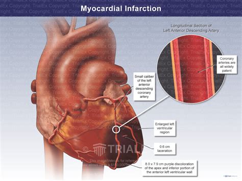 Myocardial Infarction