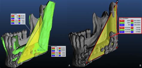 Virtual 3d Maxillary Tumor Marking Exact Intraoperative Coordinate Mapping Improve Post