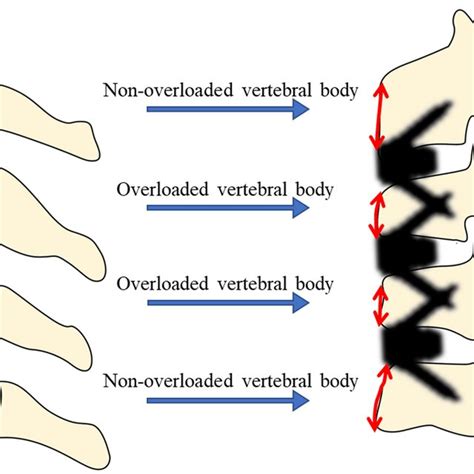 Schematic Diagram Of The Overloaded Vertebral Body Grouping Pattern