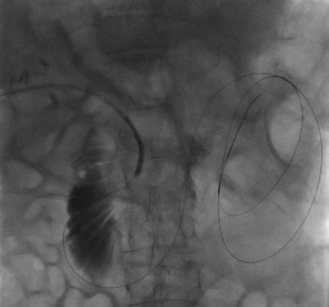 Fluoroscopic Image Demonstrating Antegrade Passage Of The Digital