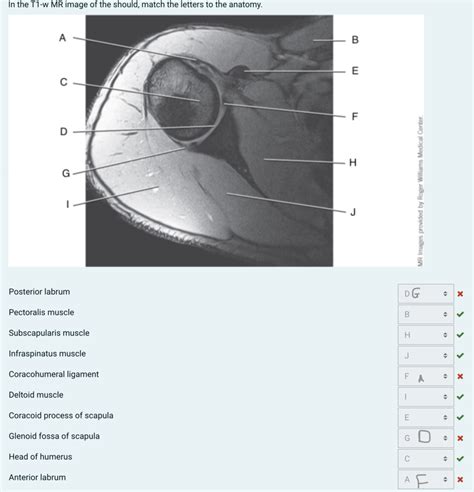 Mri Shoulder Axial Slice Diagram Quizlet