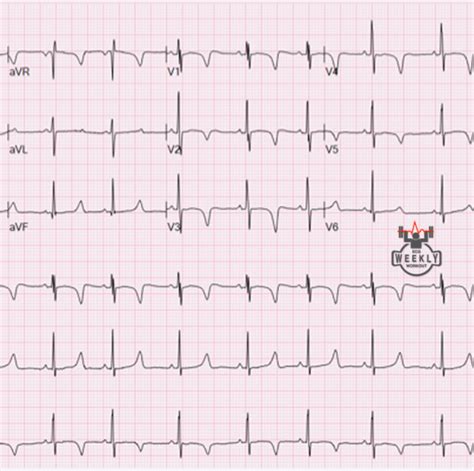 Pediatric Ecg Interval Table Ecg Weekly