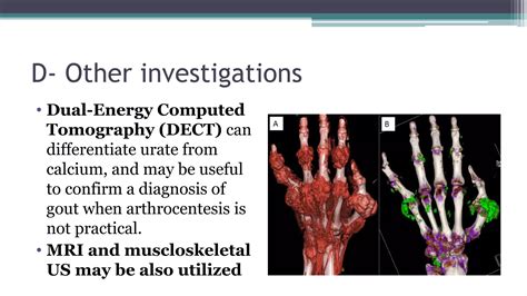Hyperuricemia And Gout Pptx