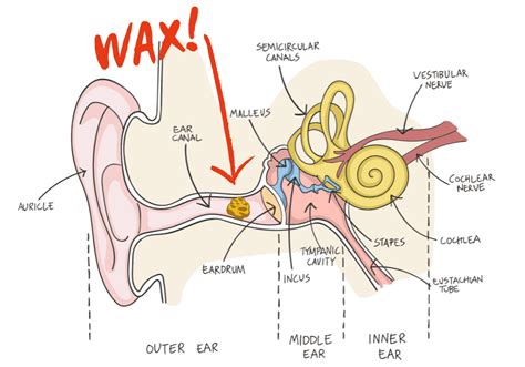 Ear Diagram With Wax At Ronald Wray Blog