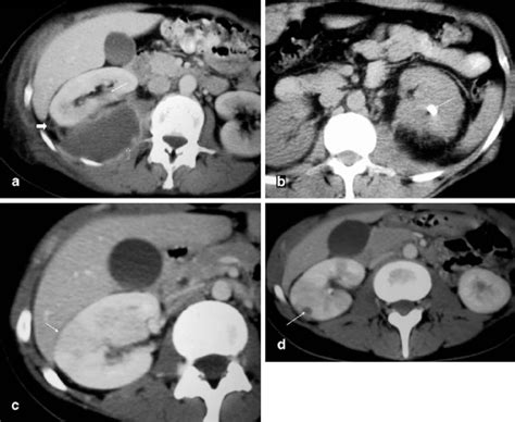 A D Acute Pyelonephritis A Contrast Enhanced Ct Scan Showing Low Download Scientific Diagram