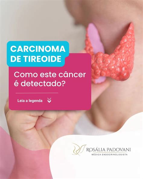 Carcinoma De Tireoide Como Este Câncer é Detectado Dra Rosália