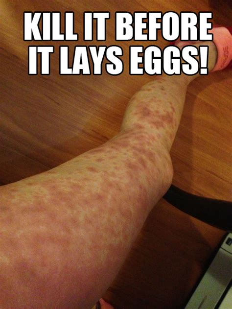 Puppp Control That Pregnancy Rash From Hell Jo Lauren