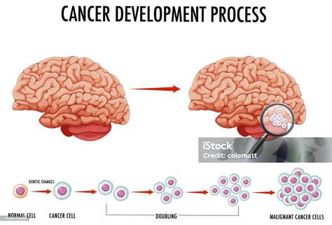 Ilustración De Diagrama Que Muestra El Cáncer En El Cerebro Humano Y
