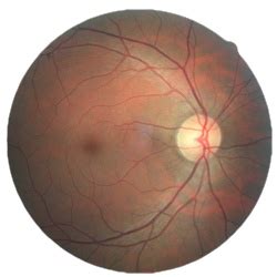 GitHub Getsanjeev Retinal Exudates Detection Exudates Detection