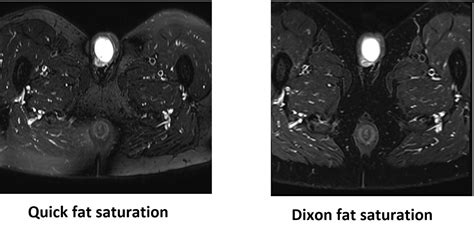 Fat Suppression Artifact Mri Lipid Suppression Artifact