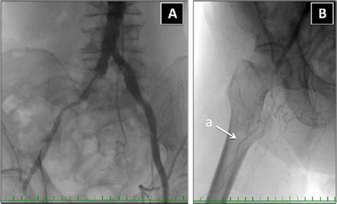 intraoperative angiogram shows long stenosis of the right iliac artery