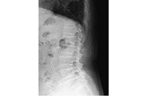 Initial Lateral Radiograph From The Previous Hospital Showing An Acute
