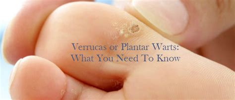 Verrucas Or Plantar Warts What You Need To Know