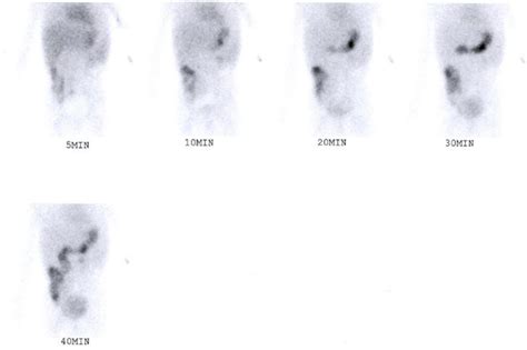 Technetium 99 M Pertechnetate Meckels Scan Showing An Abnormal Uptake Download Scientific