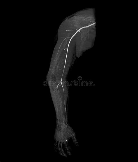 Cta Brachial Artery Or Ct Scan Of Upper Extremity 3d Rendering Image Stock Illustration