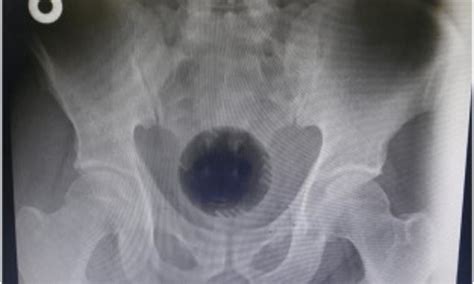 Man Gets Plastic Ball Stuck In His Anus For Two Days Daily Mail Online