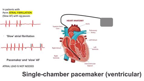Basics Of Pacemaker Dr Hafeesh Fazulu Pushpagiri Pptx Heart And Cardiovascular Diseases
