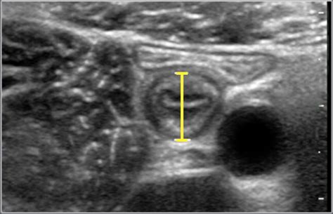 The Radiology Assistant Normal Values Ultrasound