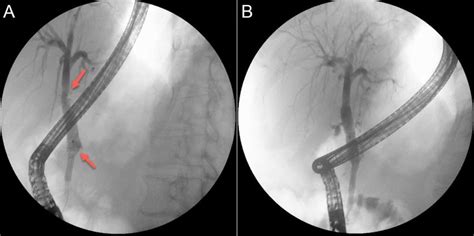 follow up cholangiogram a fully covered self expandable metal stent