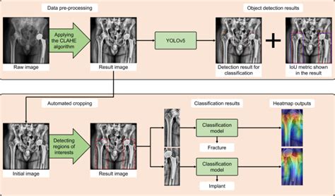 An Automated Hip Fracture Detection Classification System On Pelvic