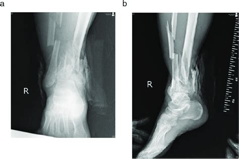 A Ap B Lateral Initial X Ray Shows Severe Comminuted Fractures In