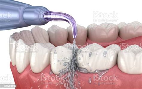 치과 세정기 물 치아 청소 구강 위생의 의학적으로 정확한 3d 그림 0명에 대한 스톡 사진 및 기타 이미지 0명 디지털 생성 이미지 물 Istock