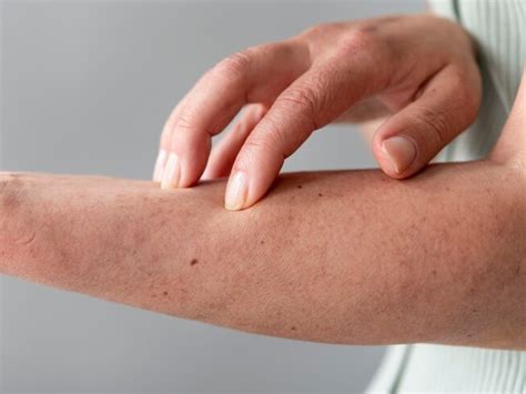 Cara Mencegah Dan Mengatasi Gejala Eksim Pada Kulit Rumah Sakit