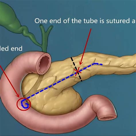 Laparoscopic Central Pancreatectomy Involving A B C D Four Steps Download Scientific Diagram