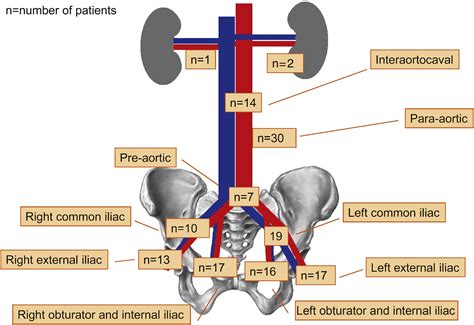 Pelvicretroperitoneal Salvage Lymph Node Dissection For Patients