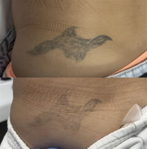 Complete Guide To Tattoo Removal Techniques And Costs