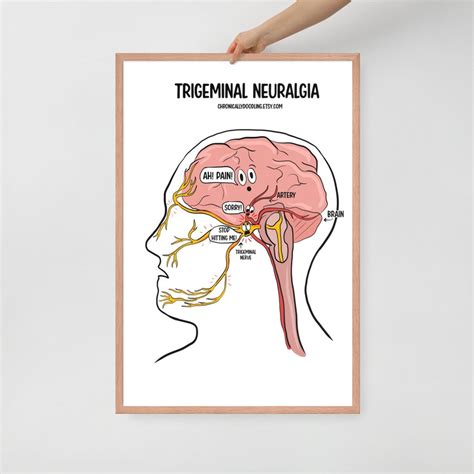 Trigeminal Neuralgia Funny Medical Diagram Framed Poster Etsy