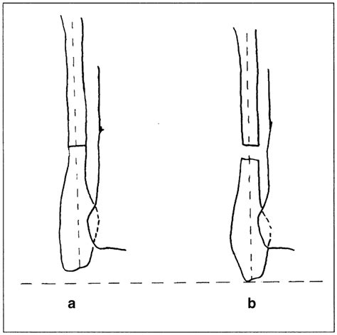 A B Diagrams Of The Right Ankle Showing A An Horizontal Osteotomy Of