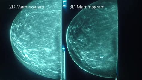 Video Mercy On Linkedin 2d Vs 3d Mammography