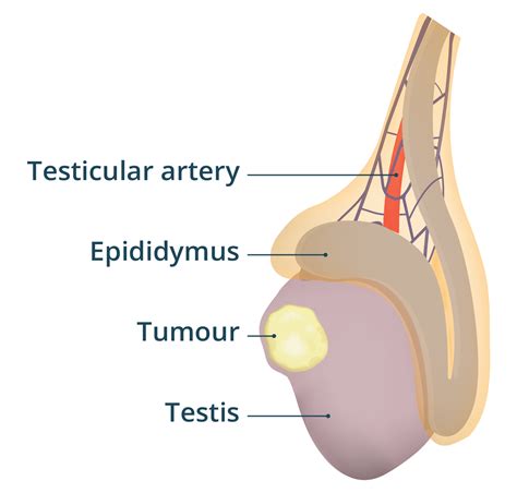 Cancer Testicular