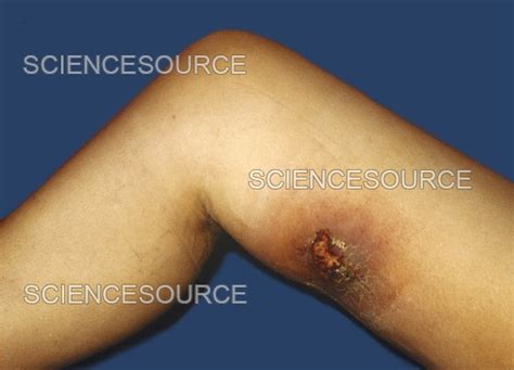 What Is Skin Infiltration
