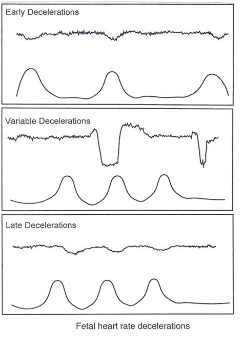 Variable Decelerations