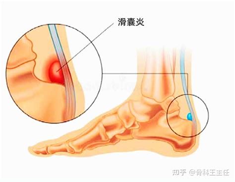 鞋子总磨脚后跟是跟腱炎还是滑囊炎有什么区别 知乎