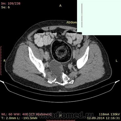 Осложнение кисты Тарлова Портал радиологов