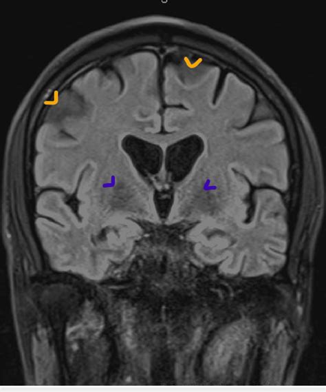 Patients Mri T2 Flair Shows Nonspecific Hyperintensities In The Download Scientific Diagram
